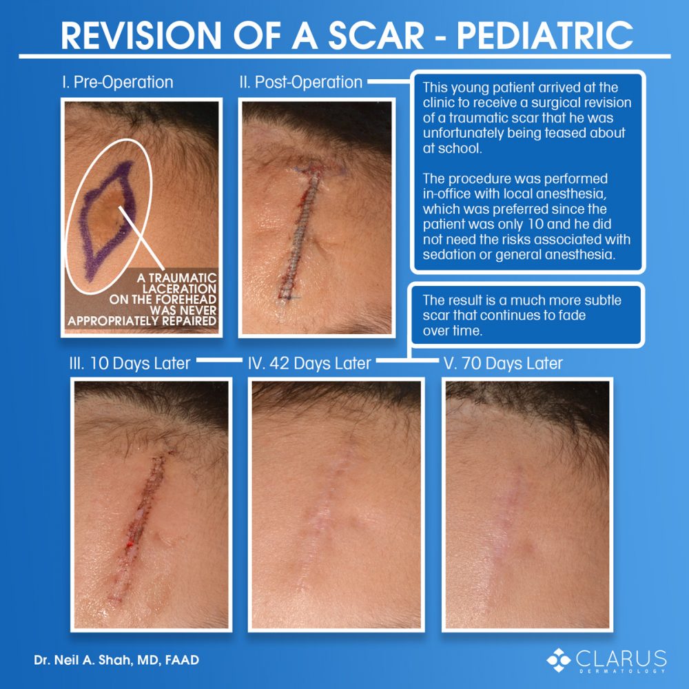 Scar Revision Surgery | Restore Confidence & Improve Skin Appearance