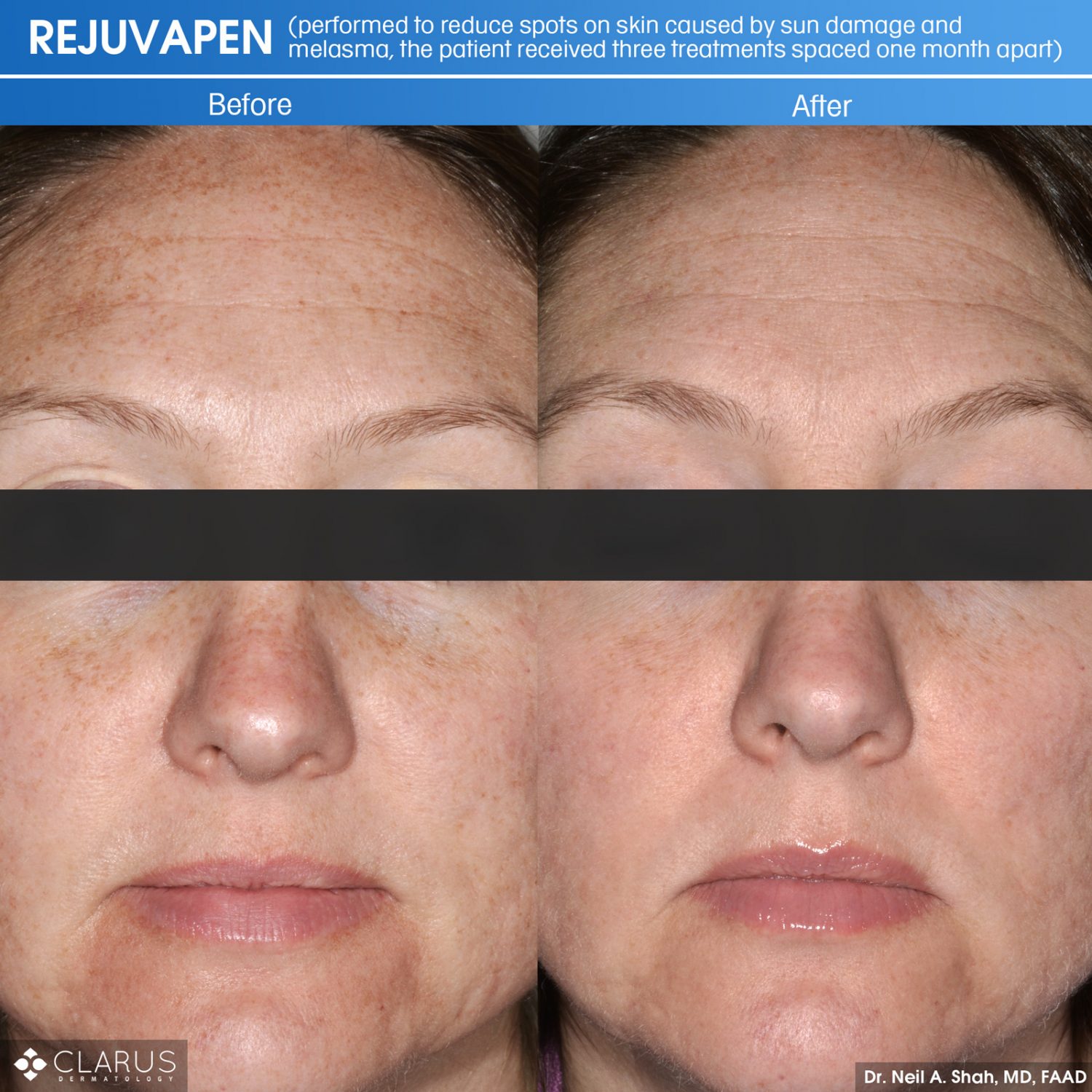 How Rejuvapen Can Help Skin Care Issues Related to Sun Damage - Clarus ...