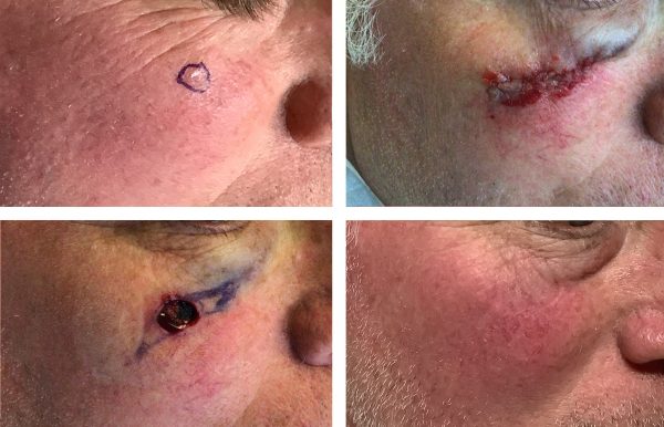 Mohs Surgery | Skin Cancer Removal with Maximum Preservation