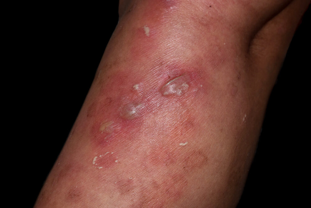 Skin Infection Treatments | Clarus Dermatology