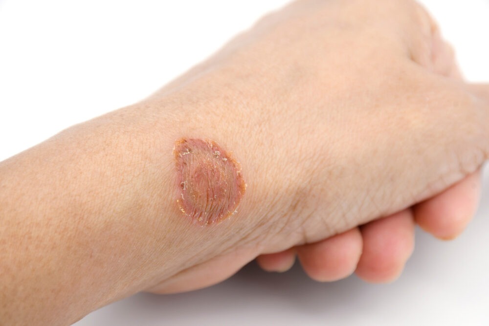 Skin Infection Treatments | Clarus Dermatology