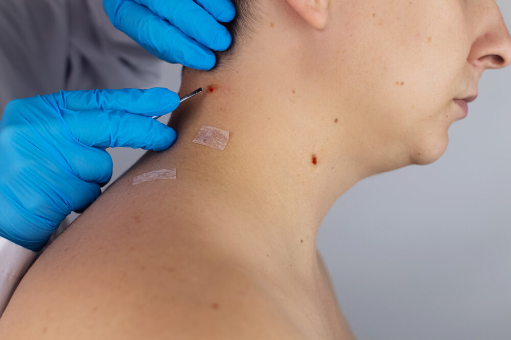 Excision of Skin Lesions | Surgical Removal by Clarus Dermatology
