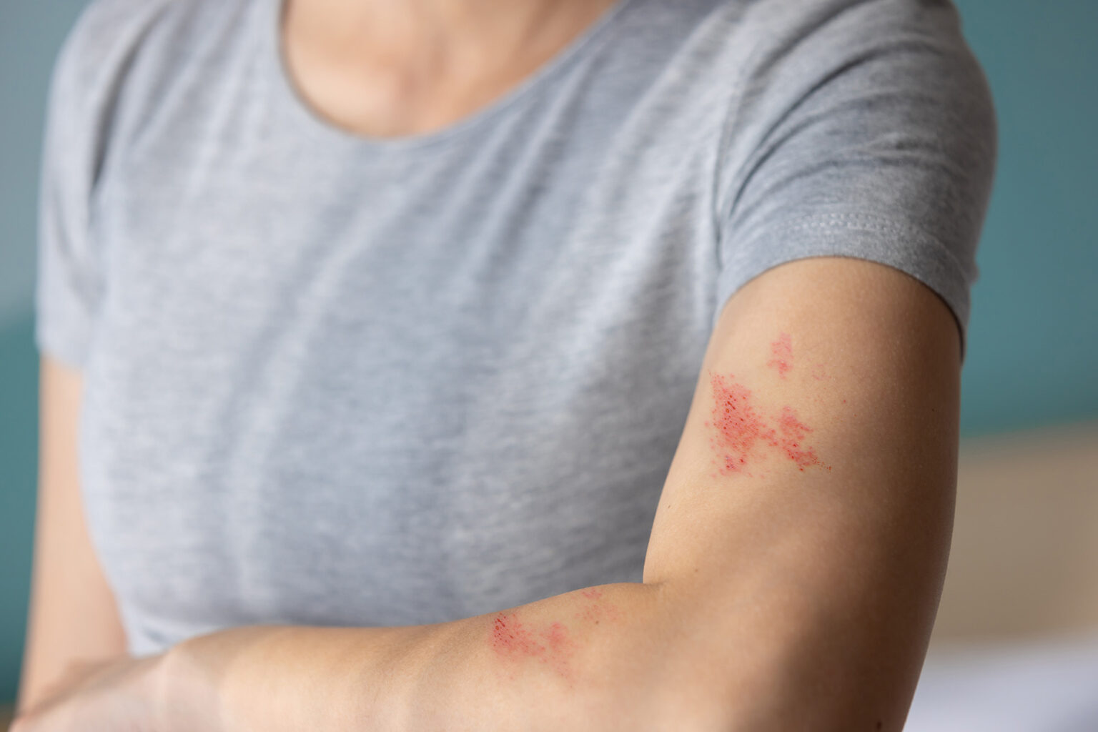 Fungal, Bacterial, or Viral Skin Infection? How to Tell the Difference ...
